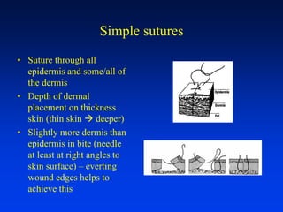 Wound Suturing & Skin Flaps May11 | PPT