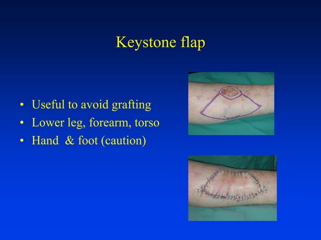 Wound Suturing & Skin Flaps May11