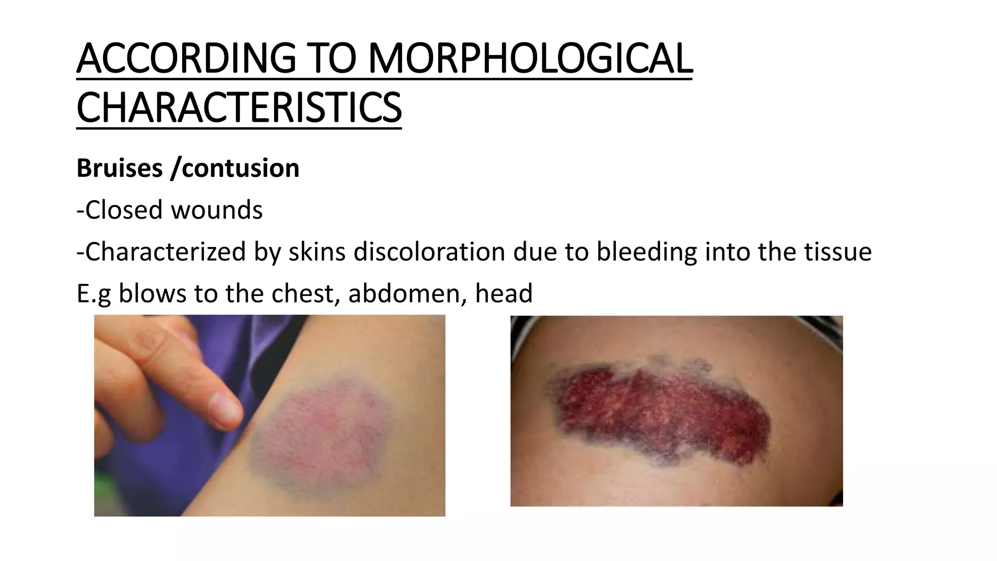 WOUNDS, WOUND HEALING AND SURGICAL SITE INFECTIONS-1.pptx