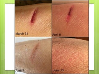 Wound, tissue repair and scar | PDF