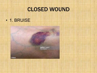 WOUND TYPE AND HEALING.pptx