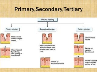 WOUND TYPE AND HEALING.pptx