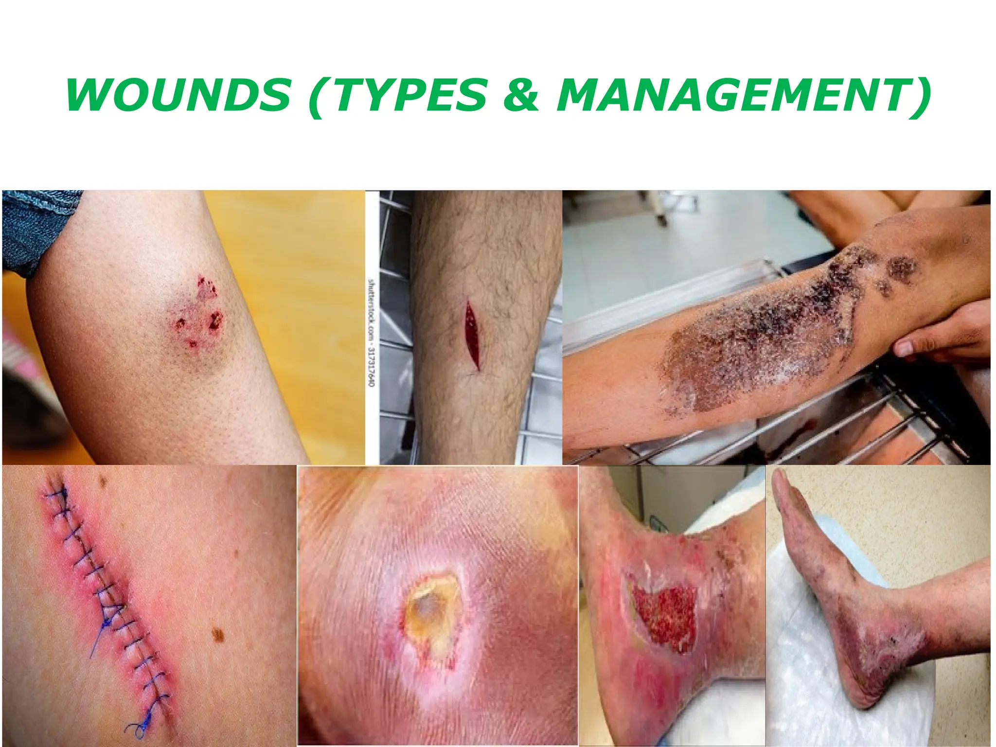 Wound (Types, Factors affecting healing and Management).pptx