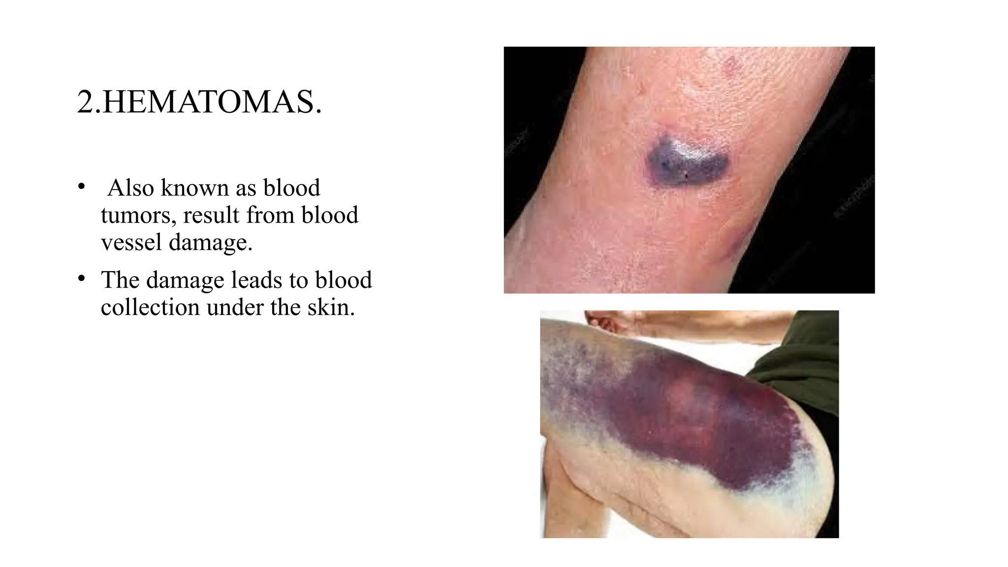 WOUND ULCERS : introduction , types, stages of healing , management ...