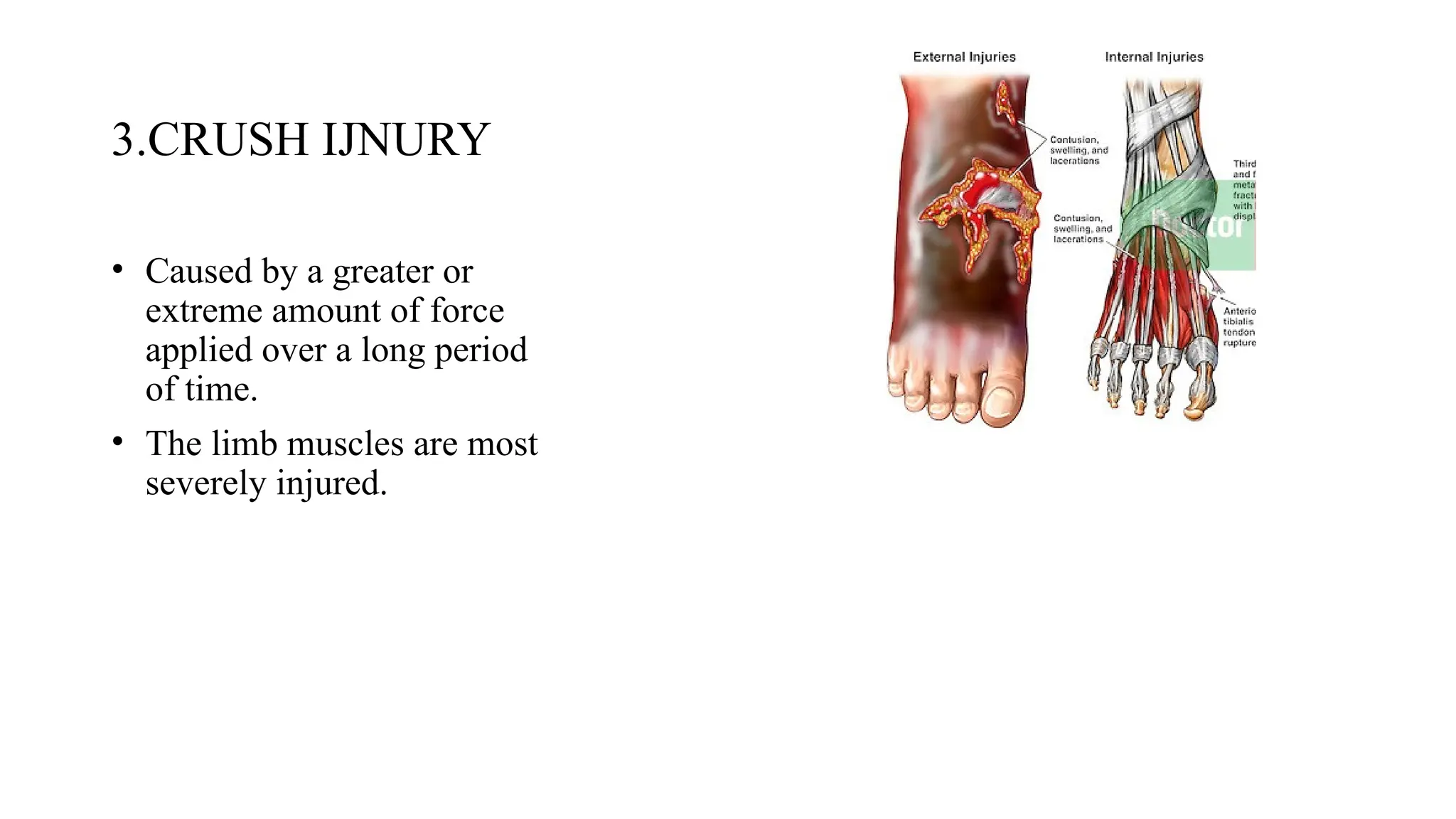 WOUND ULCERS : introduction , types, stages of healing , management ...