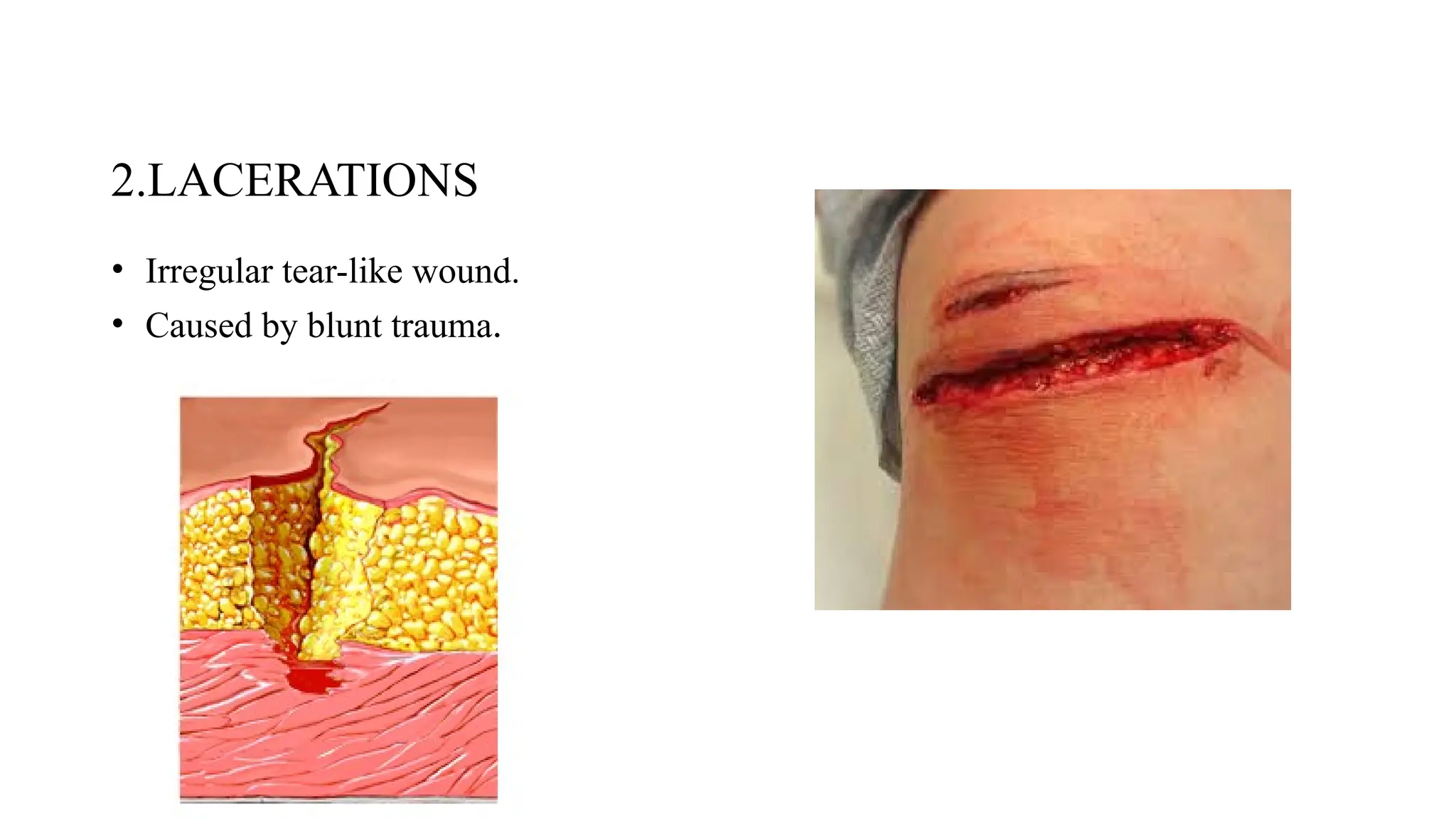WOUND ULCERS : introduction , types, stages of healing , management ...