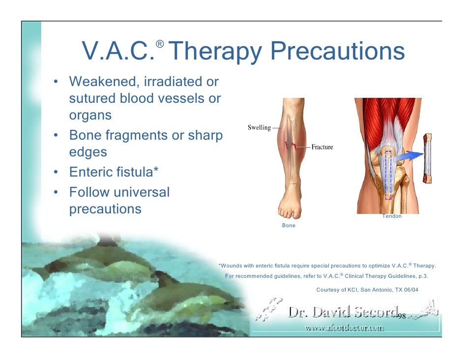 Wound Vac Lecture wound-vac-lecture