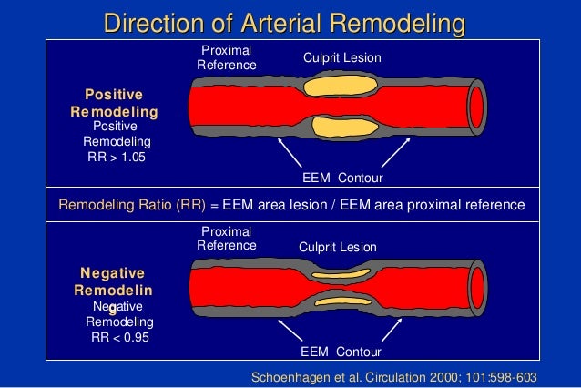 Arterial remodeling in stable versus unstable coronary syndromes