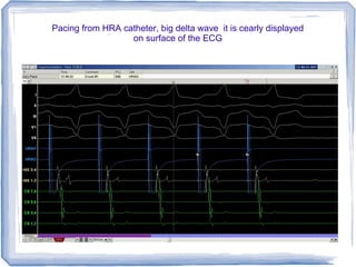 Accessories Pathway/WPW | ODP