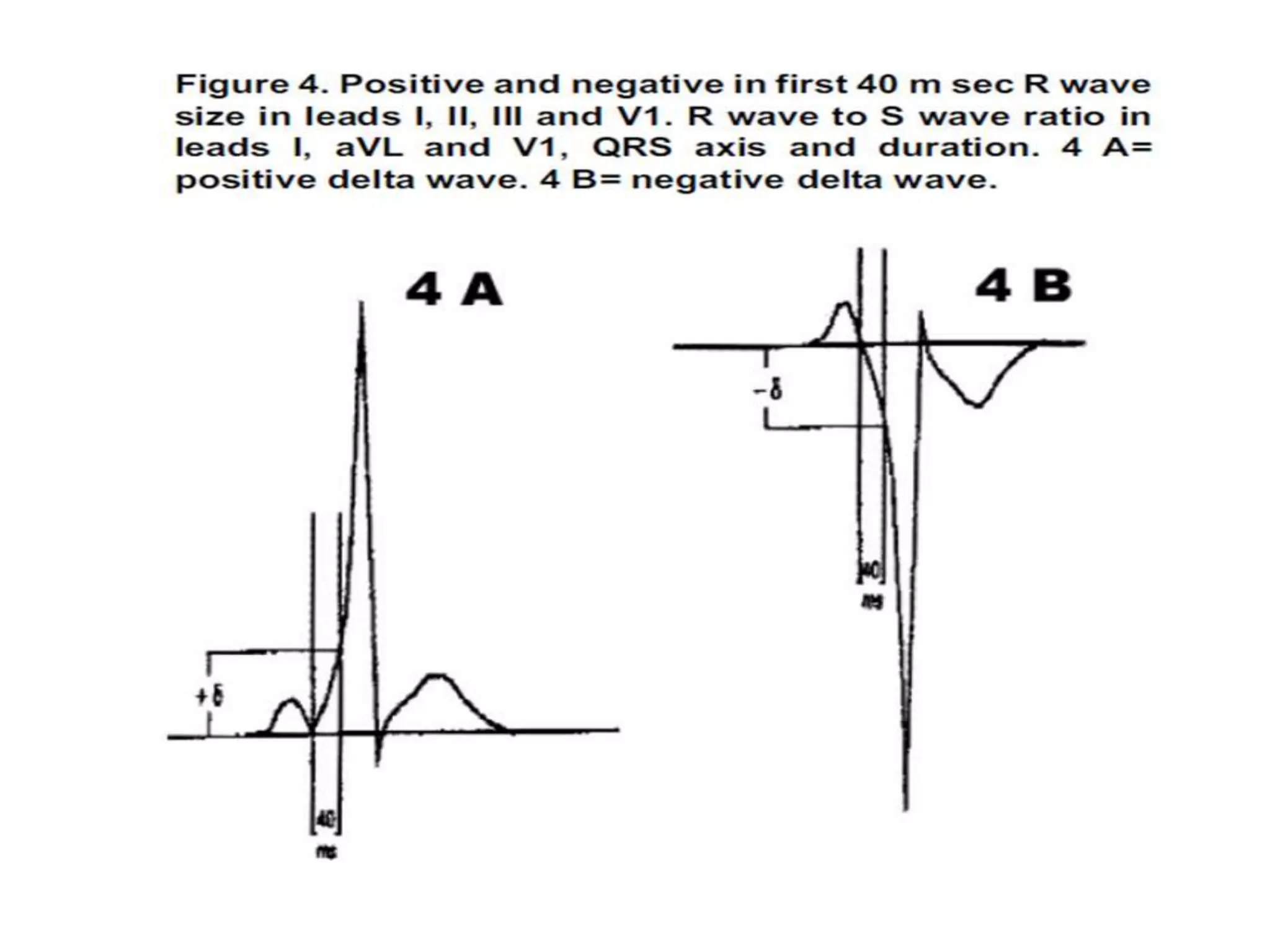 Localization of WPW( accessory Pathway) by surface ECG | PPTX