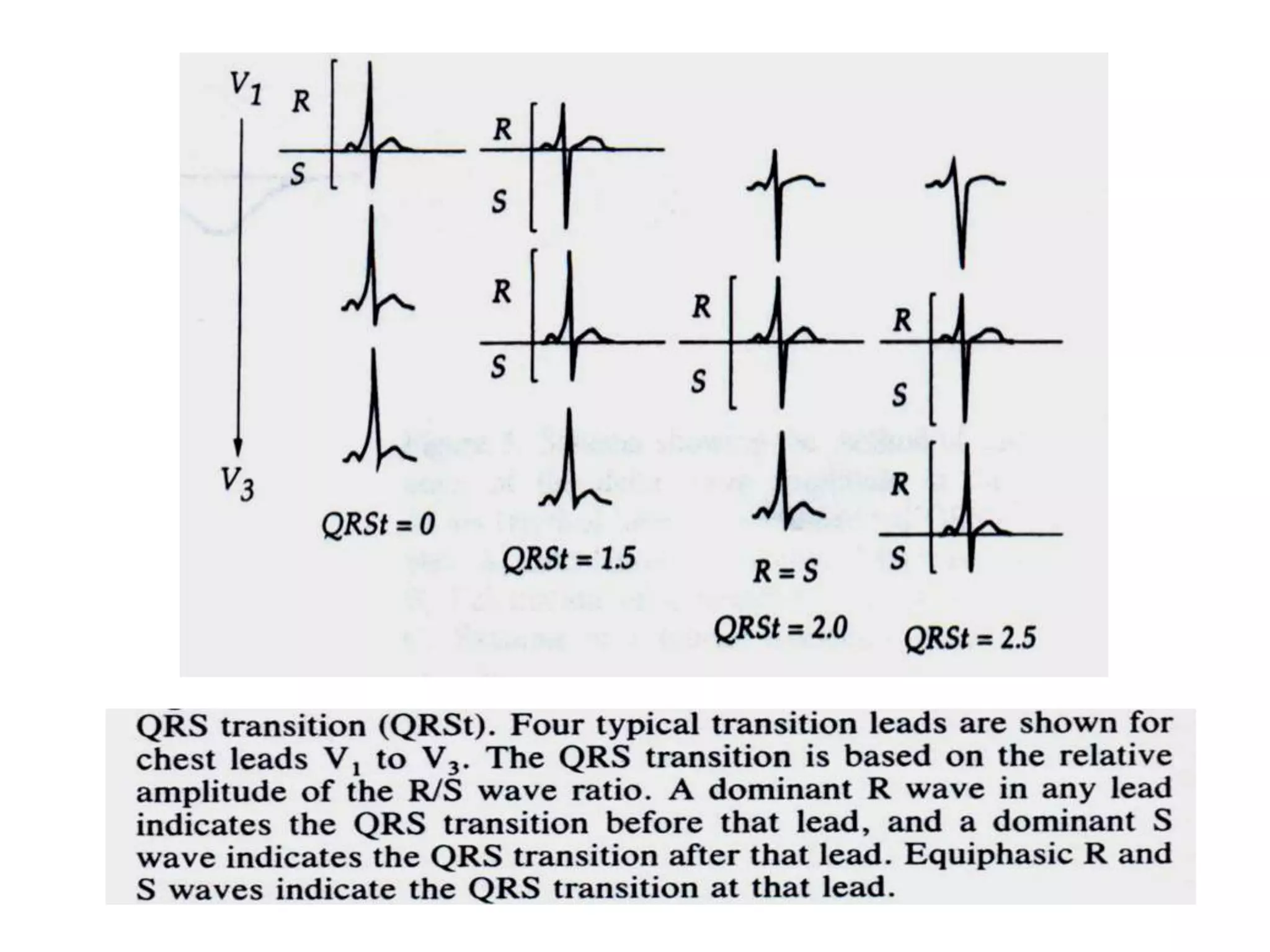 Localization of WPW( accessory Pathway) by surface ECG | PPTX