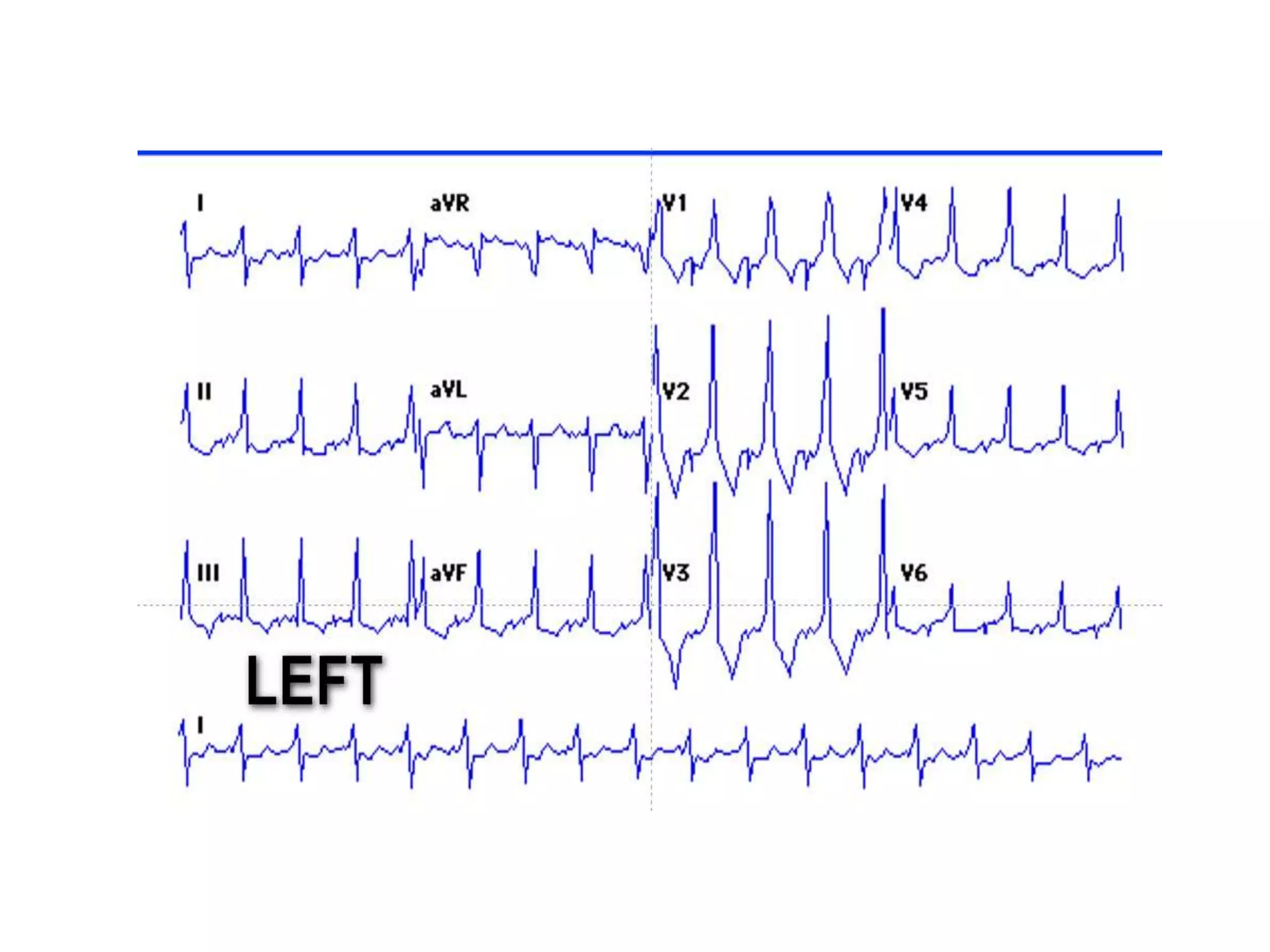Localization of WPW( accessory Pathway) by surface ECG | PPTX