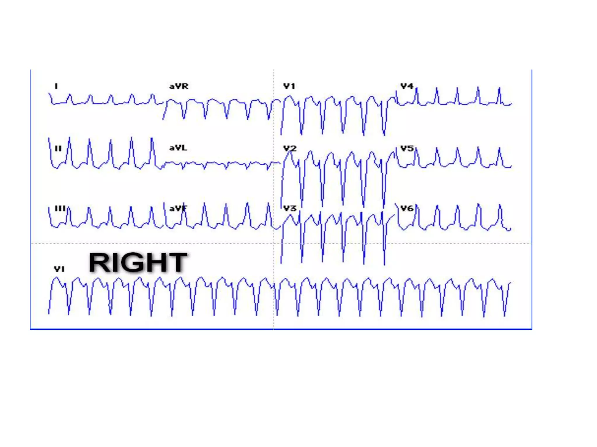 Localization of WPW( accessory Pathway) by surface ECG | PPTX