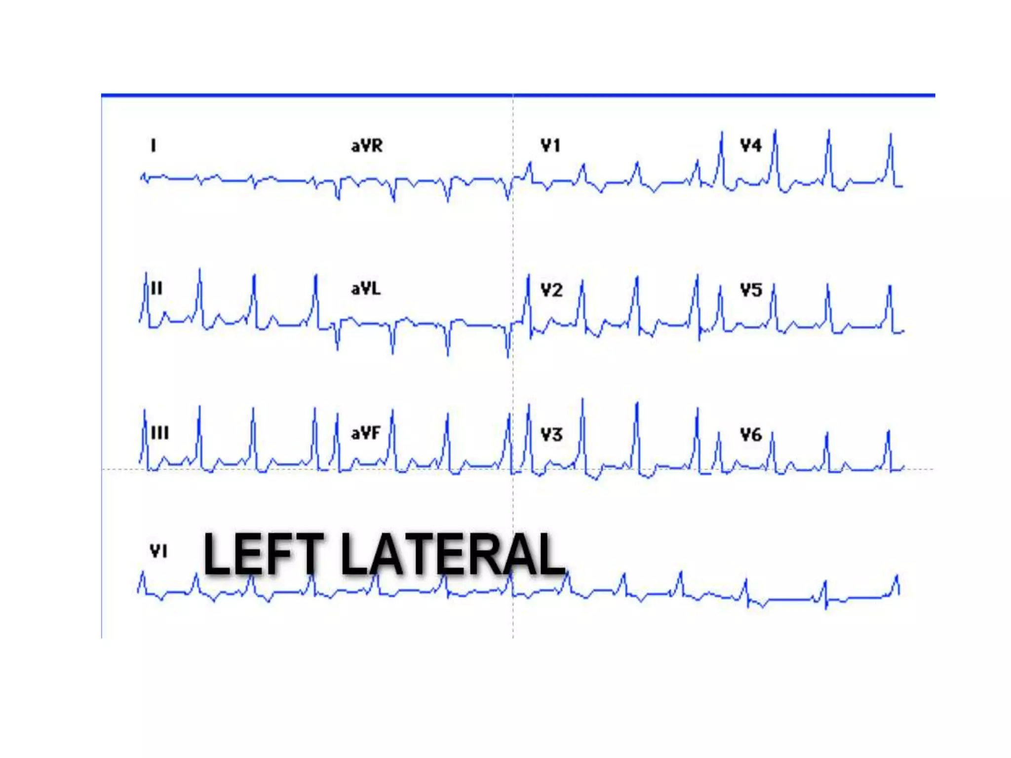 Localization of WPW( accessory Pathway) by surface ECG | PPTX