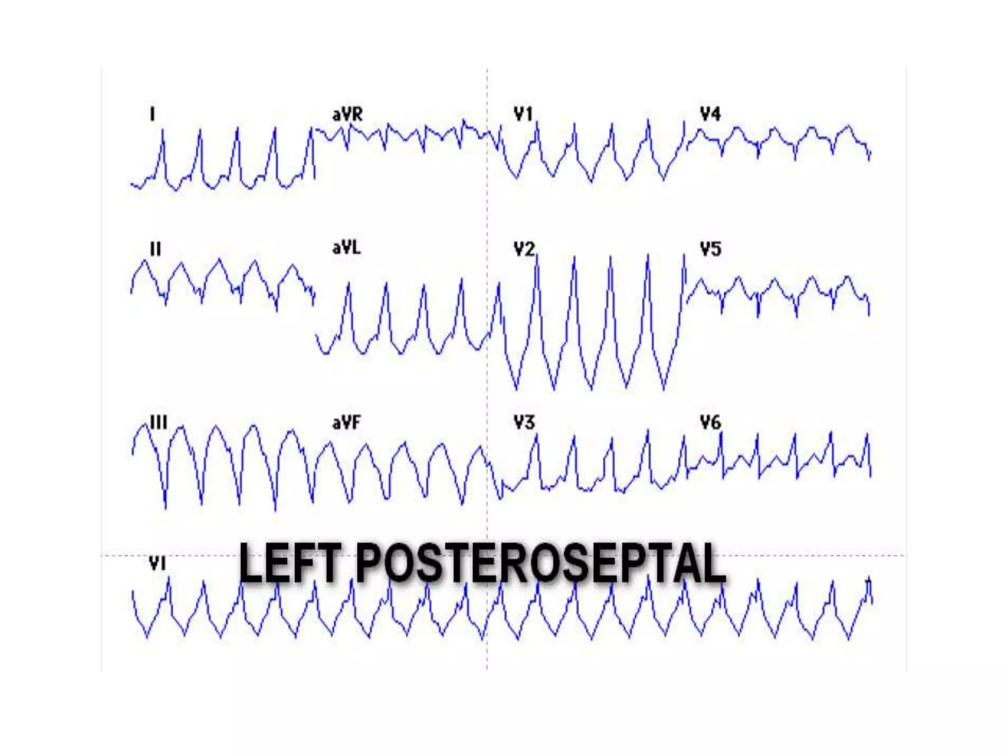 Localization of WPW( accessory Pathway) by surface ECG | PPTX