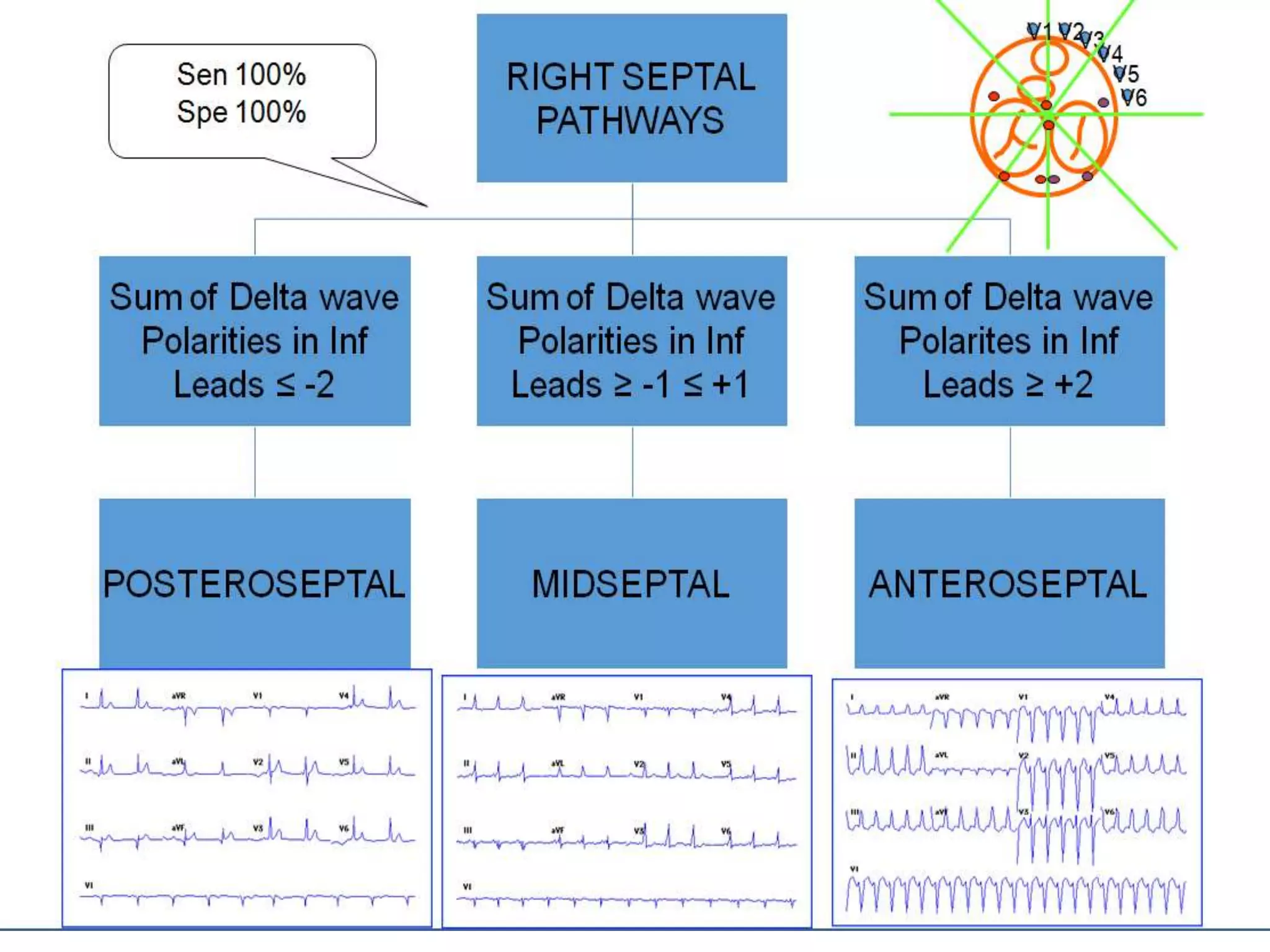 Localization of WPW( accessory Pathway) by surface ECG | PPTX