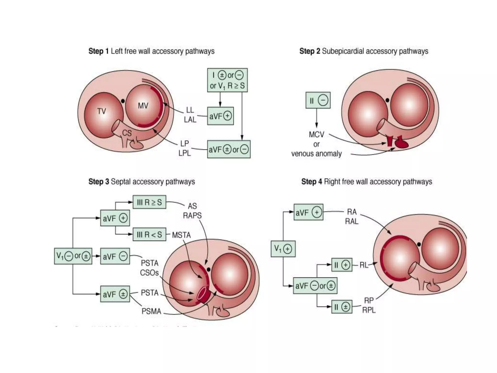 Localization Of Wpw Accessory Pathway By Surface Ecg Pptx