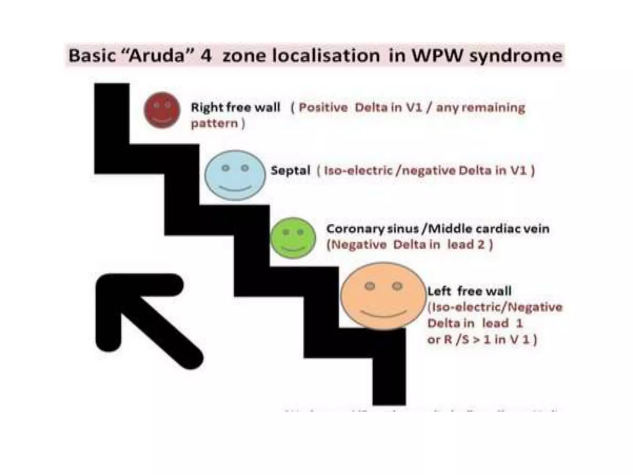 Localization of WPW( accessory Pathway) by surface ECG | PPTX