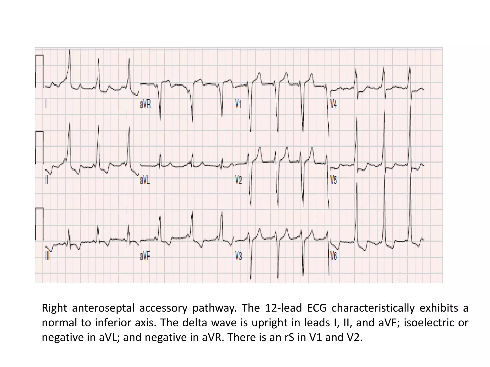 Localization of WPW( accessory Pathway) by surface ECG | PPTX