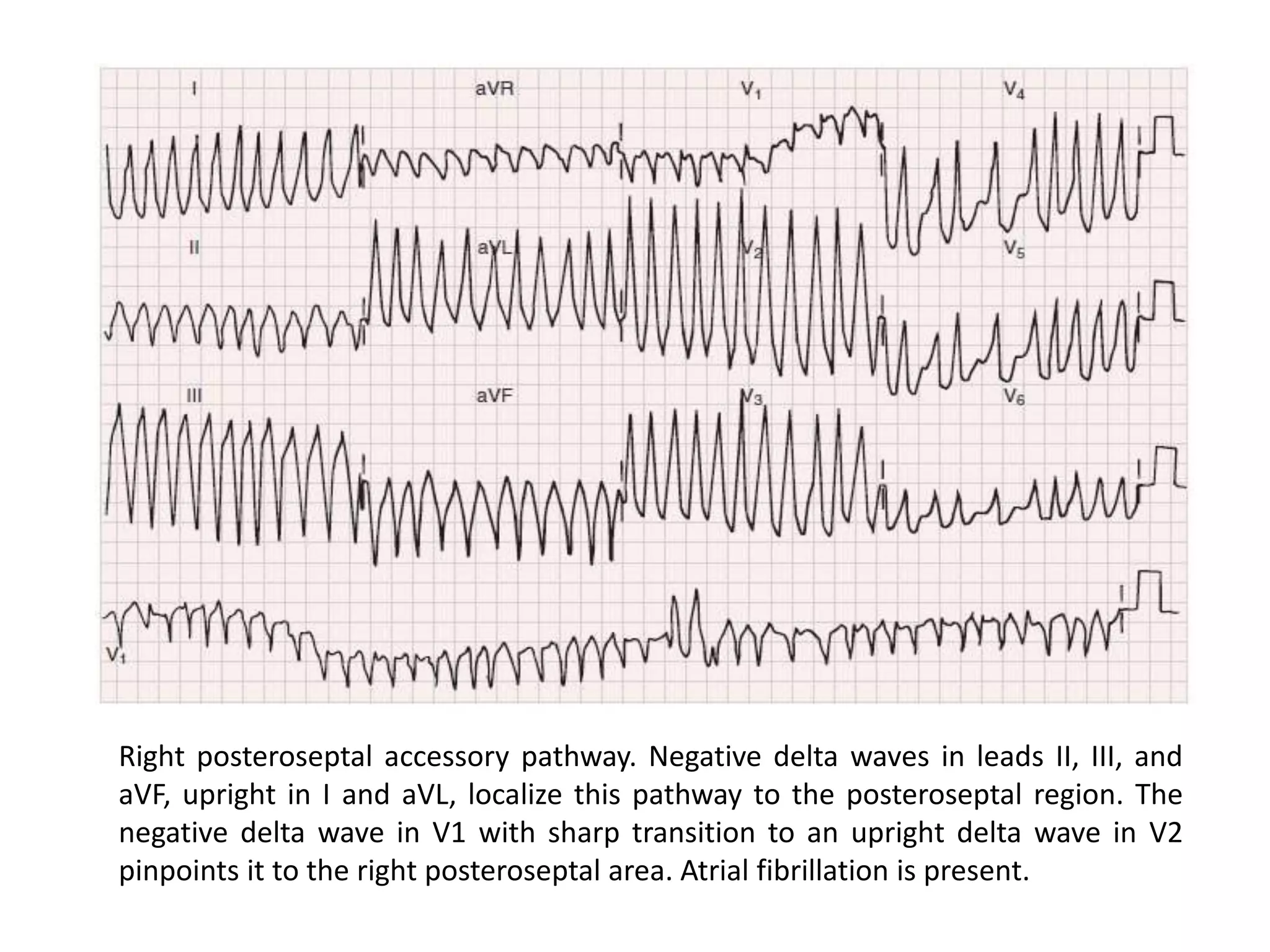 Localization of WPW( accessory Pathway) by surface ECG | PPTX