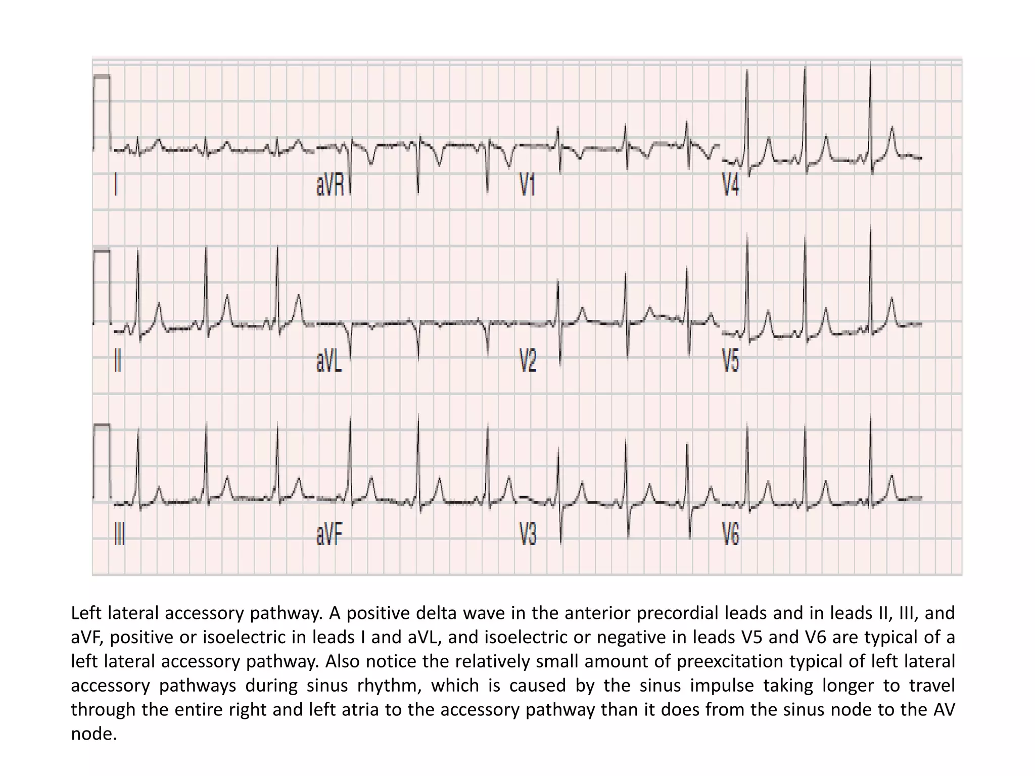 Localization of WPW( accessory Pathway) by surface ECG | PPTX