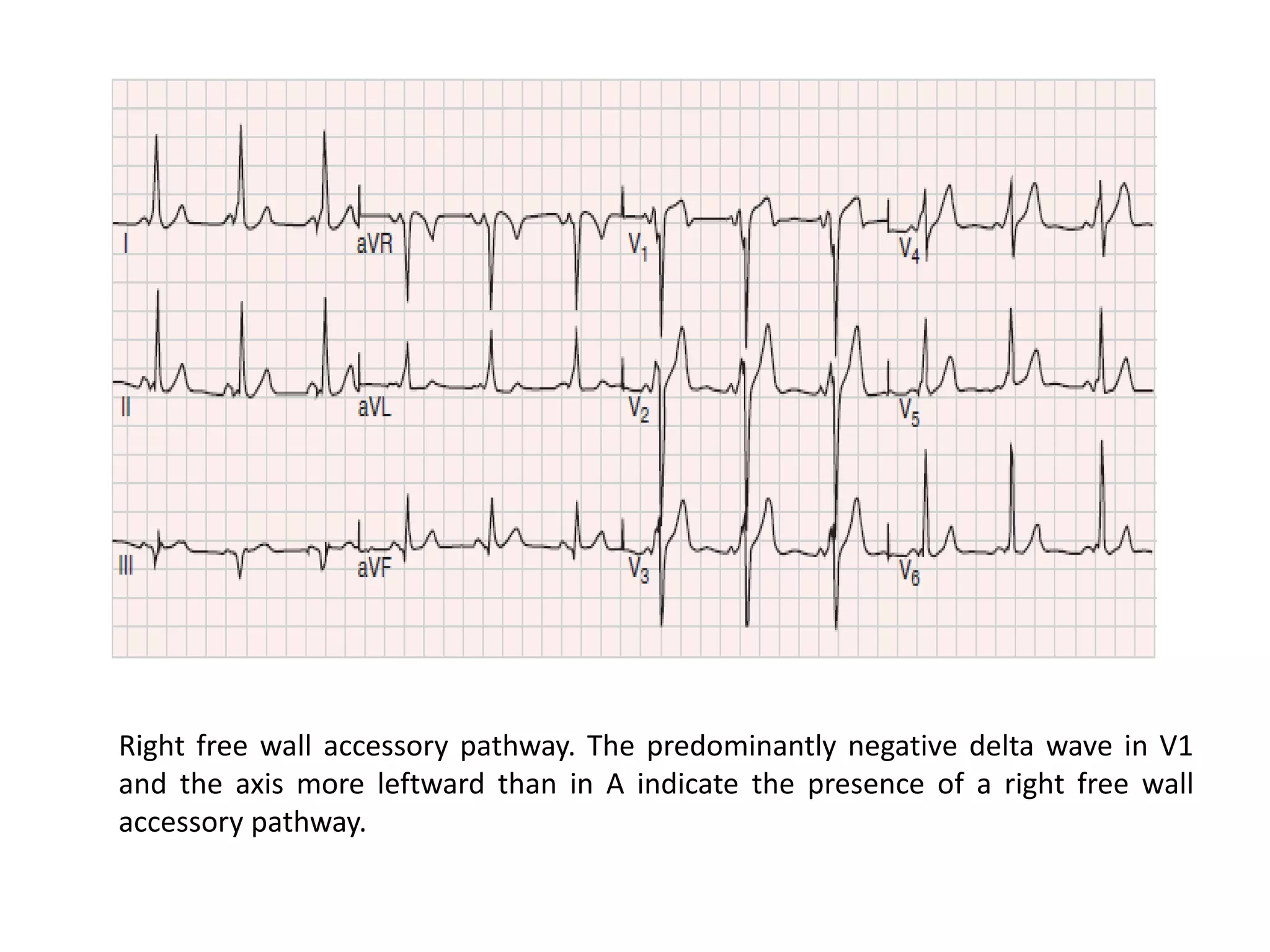 Localization of WPW( accessory Pathway) by surface ECG | PPTX