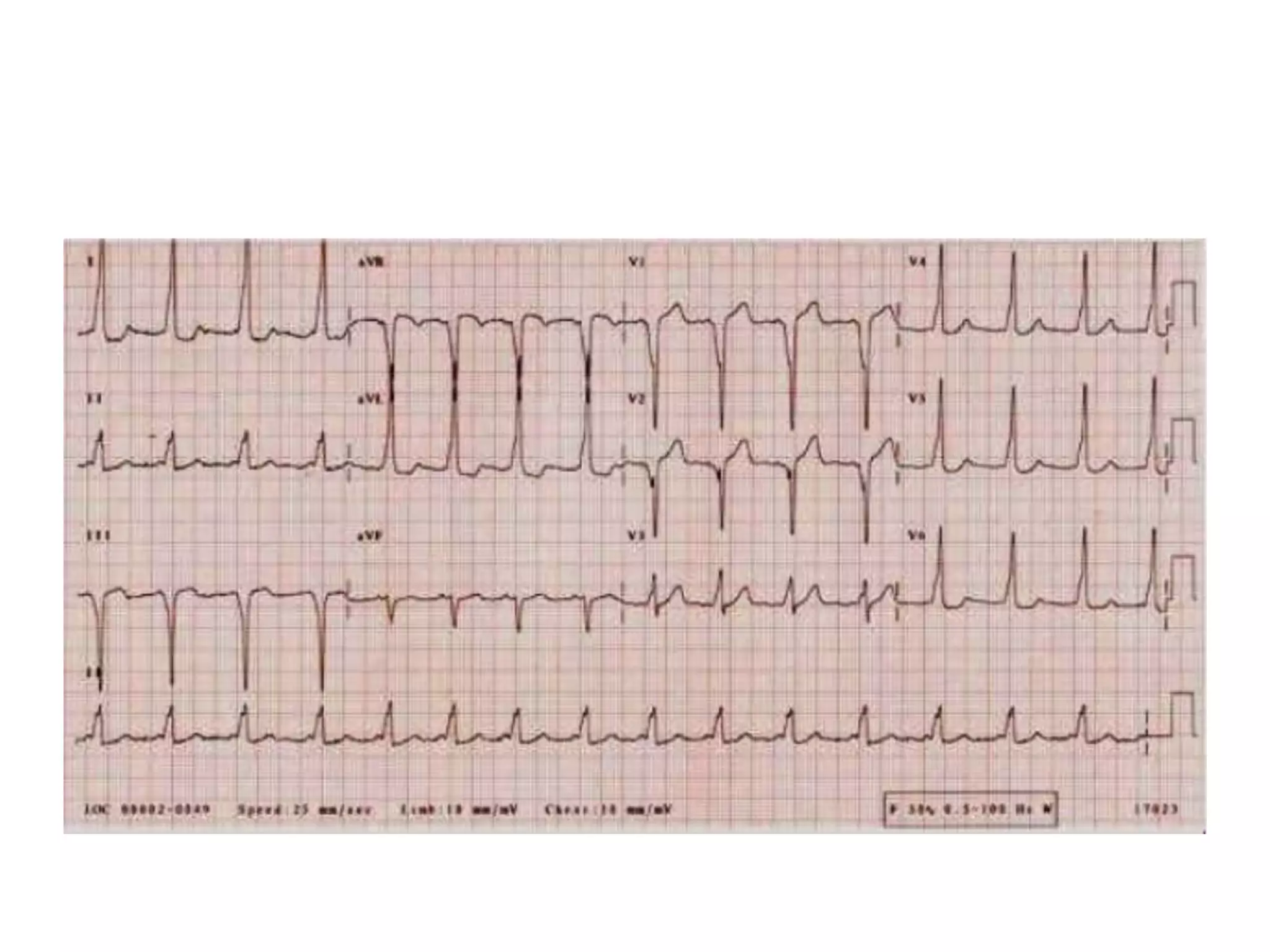 Localization of WPW( accessory Pathway) by surface ECG | PPTX
