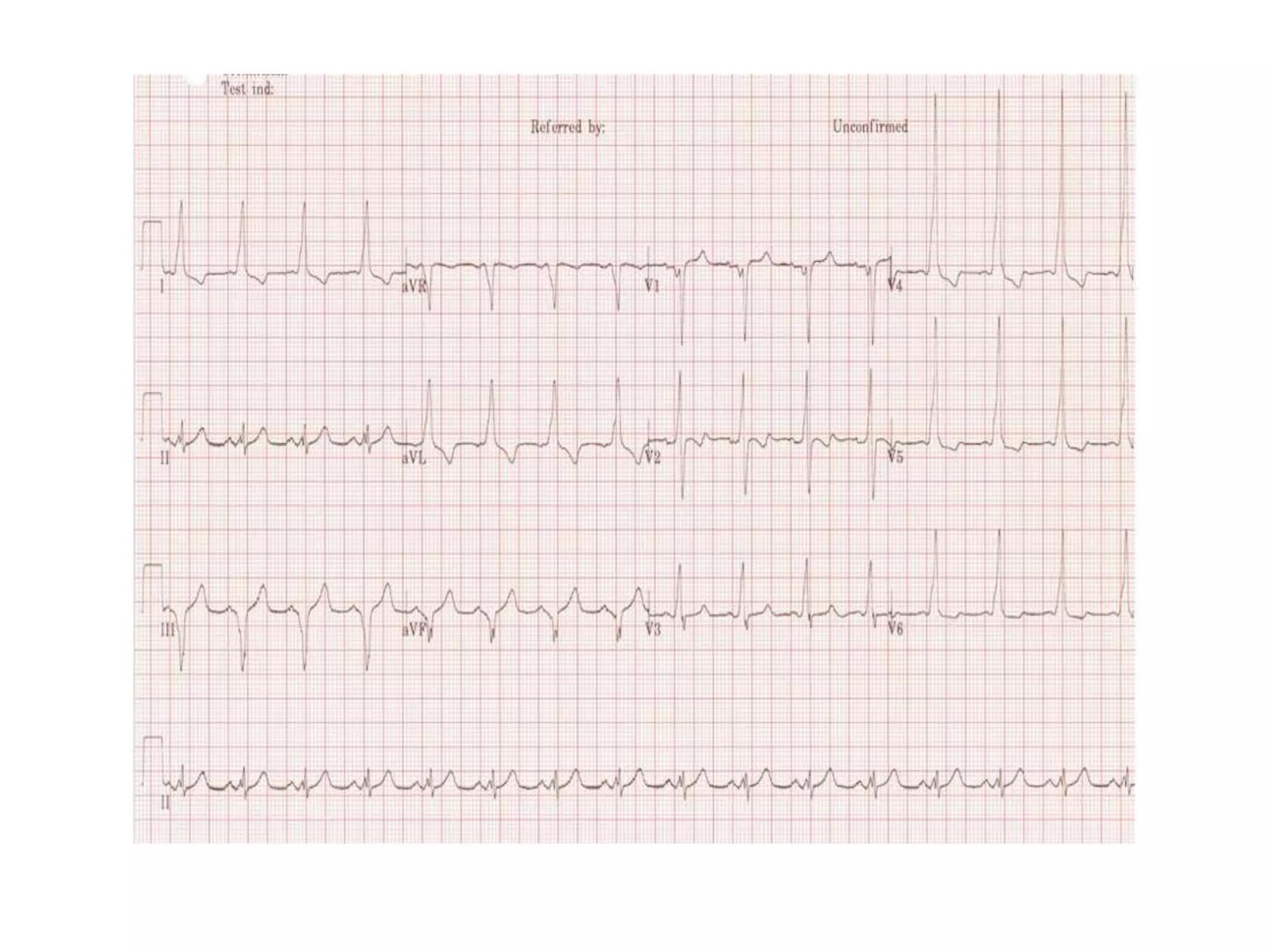 Localization of WPW( accessory Pathway) by surface ECG | PPTX