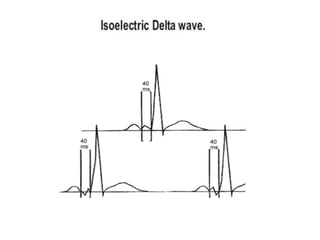Localization of WPW( accessory Pathway) by surface ECG | PPTX