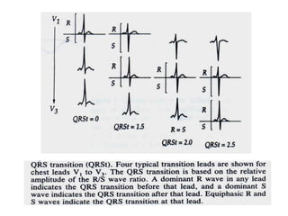 Localization of WPW( accessory Pathway) by surface ECG | PPTX