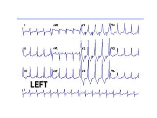 Localization of WPW( accessory Pathway) by surface ECG | PPTX