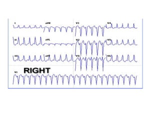 Localization of WPW( accessory Pathway) by surface ECG | PPTX
