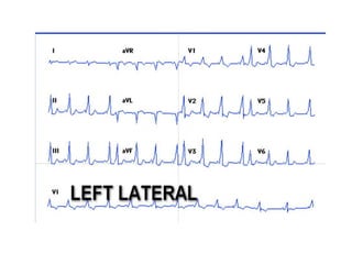 Localization of WPW( accessory Pathway) by surface ECG | PPTX