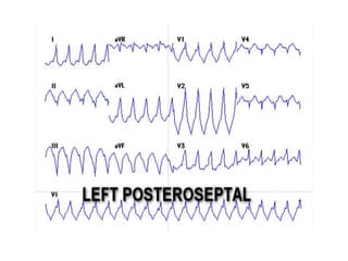 Localization of WPW( accessory Pathway) by surface ECG | PPTX