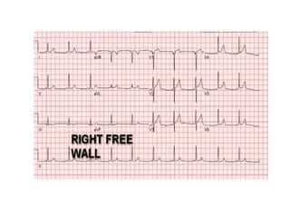 Localization of WPW( accessory Pathway) by surface ECG | PPTX