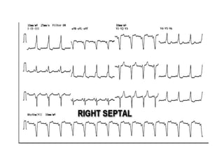 Localization of WPW( accessory Pathway) by surface ECG | PPTX