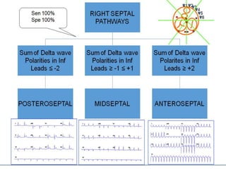 Localization of WPW( accessory Pathway) by surface ECG | PPTX