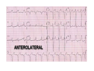 Localization of WPW( accessory Pathway) by surface ECG | PPTX