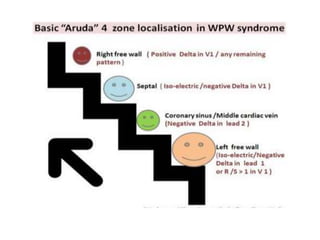 Localization of WPW( accessory Pathway) by surface ECG | PPTX