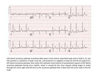Localization of WPW( accessory Pathway) by surface ECG | PPTX