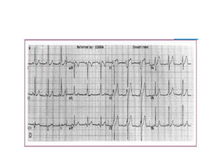 Localization of WPW( accessory Pathway) by surface ECG | PPTX