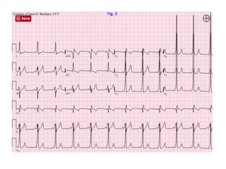 Localization of WPW( accessory Pathway) by surface ECG | PPTX