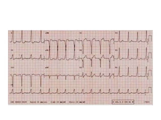 Localization of WPW( accessory Pathway) by surface ECG | PPTX