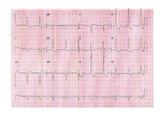 Localization of WPW( accessory Pathway) by surface ECG | PPTX