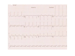 Localization of WPW( accessory Pathway) by surface ECG | PPTX