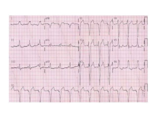 Localization of WPW( accessory Pathway) by surface ECG | PPTX