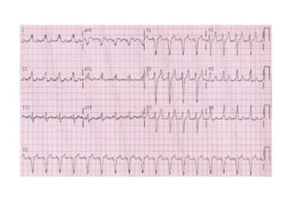Localization of WPW( accessory Pathway) by surface ECG | PPTX