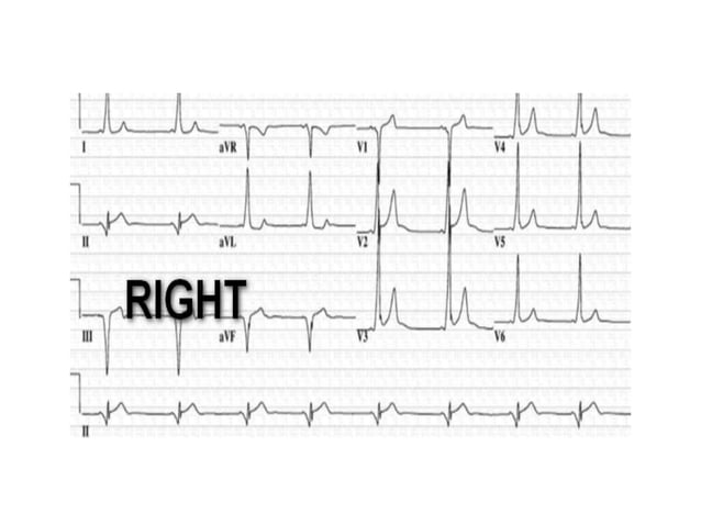 Localization of WPW( accessory Pathway) by surface ECG | PPT