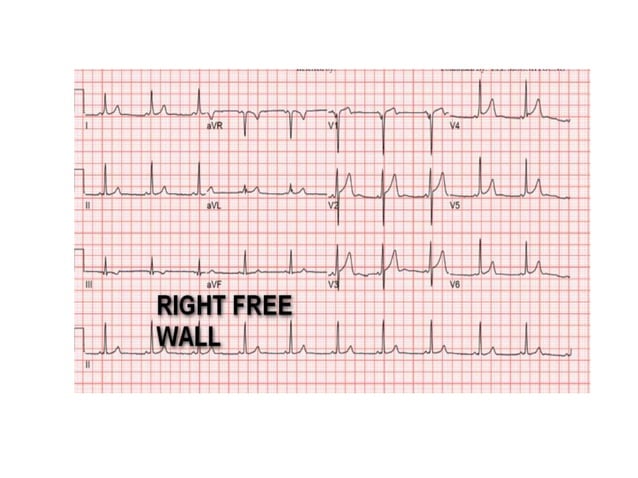 Localization of WPW( accessory Pathway) by surface ECG | PPT