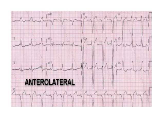Localization of WPW( accessory Pathway) by surface ECG | PPT